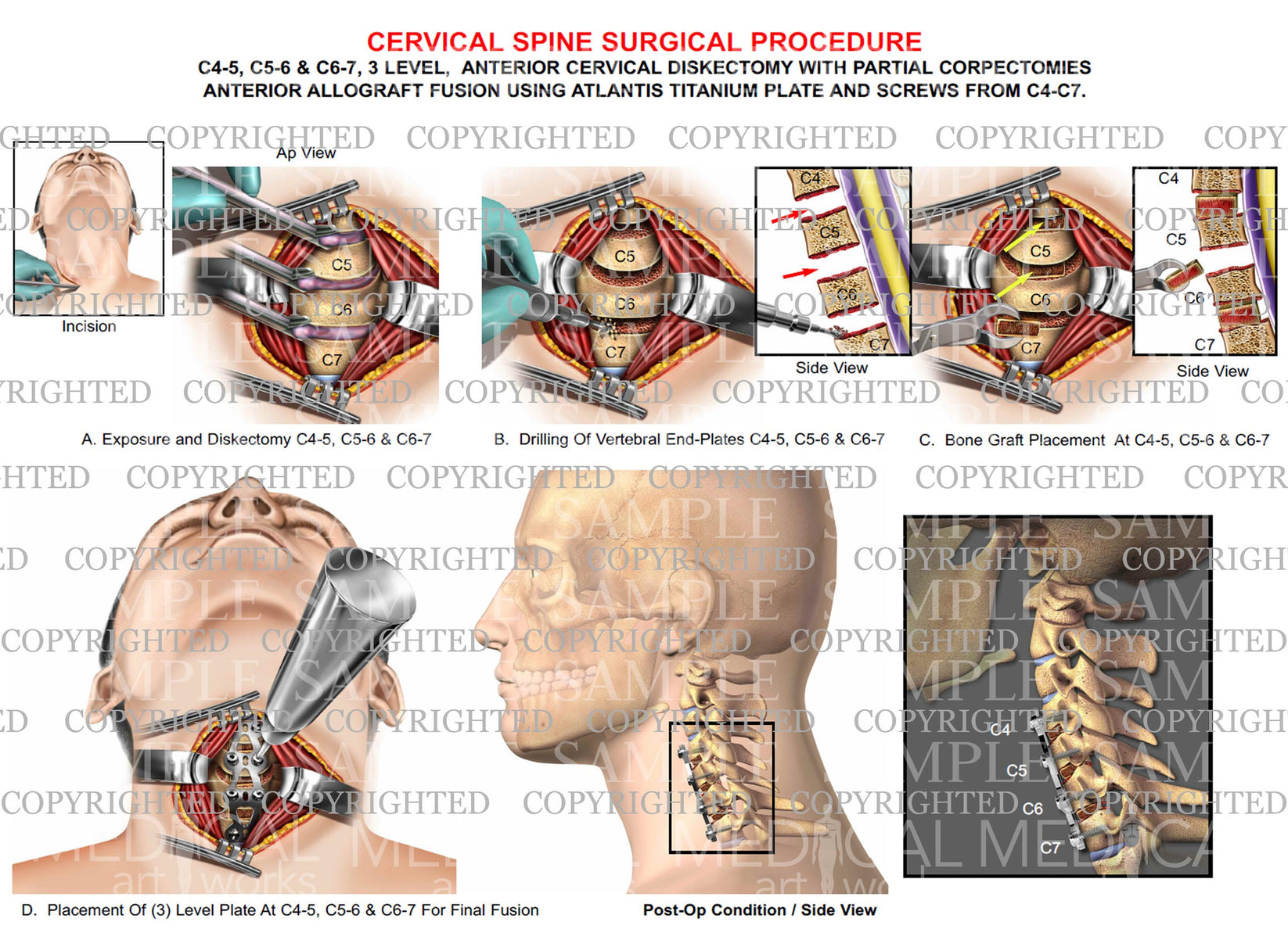 C4-5, C5-6 & C6-7 cervical discectomy + fusion – Medical Art Works