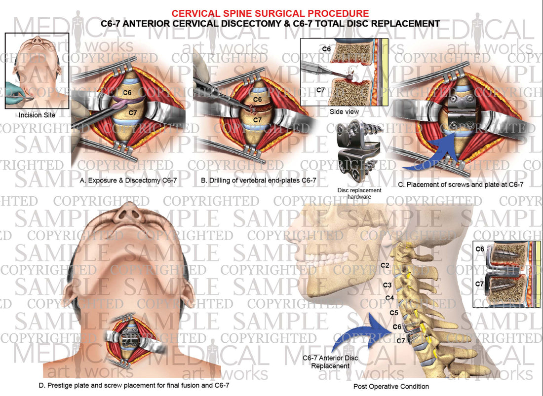 1 Level - C6-C7 anterior cervical discectomy and fusion - cervical art ...