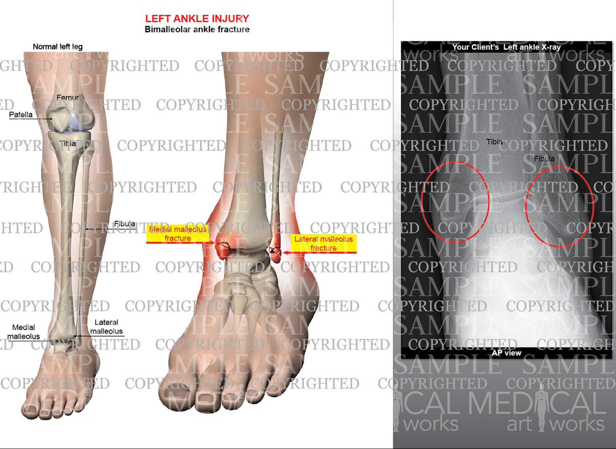 Left ankle bimalleolar fracture with injury x-ray – Medical Art Works