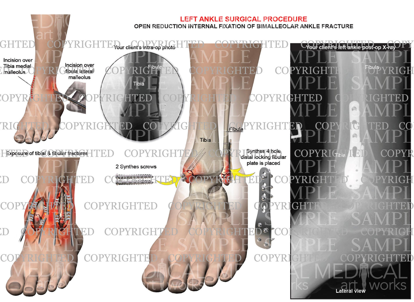 Left ankle and tibia bimalleolar fracture -ORIF – Medical Art Works