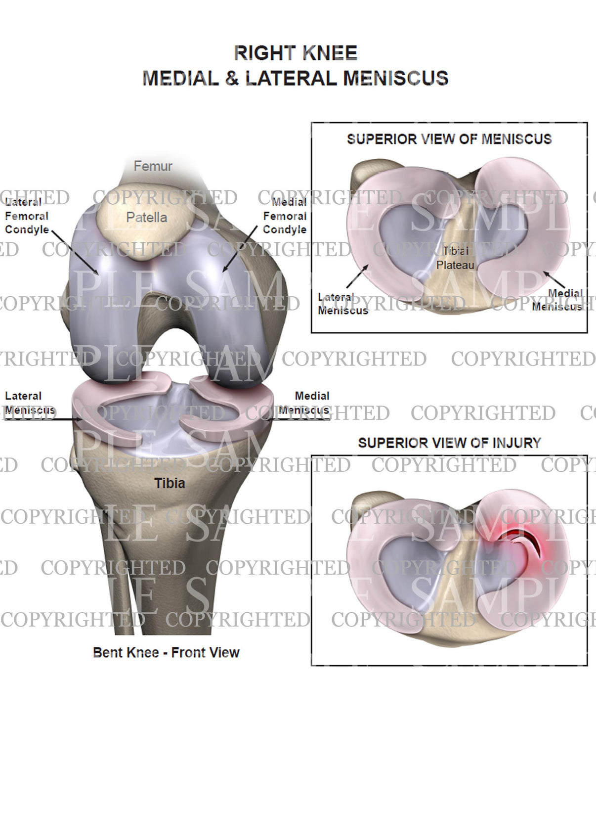 Right knee meniscus tear – Medical Art Works