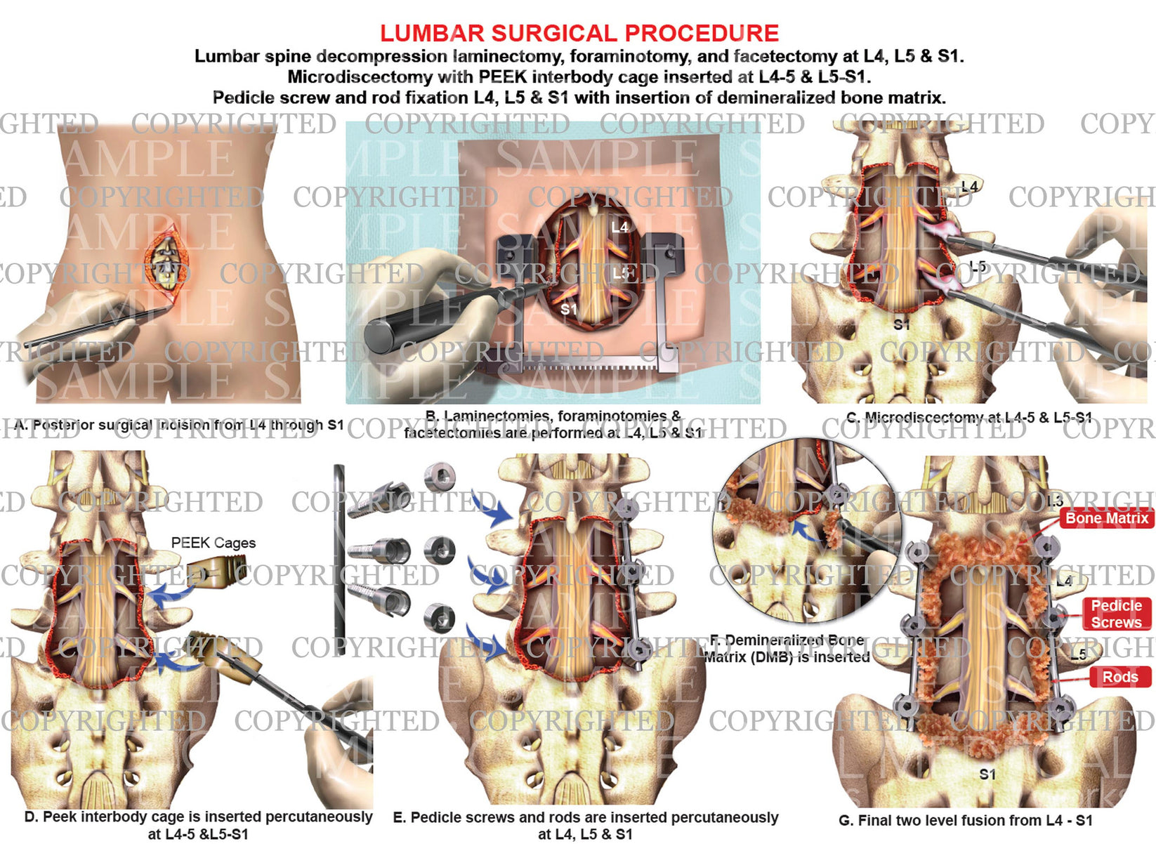 2 level - L4, L5, S1 Lumbar interbody fusion, decompression & discecto ...