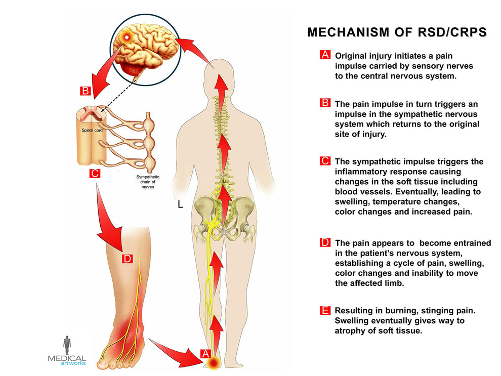 MECHANISM OF RSD: Reflex Sympathetic Dystrophy (Complex Regional Pain ...