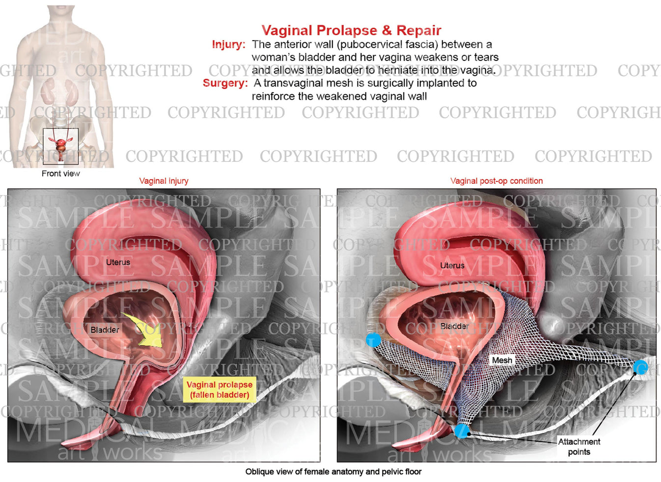Vaginal Prolapse Cystocele Fallen Bladder And Transvaginal Mesh Repa